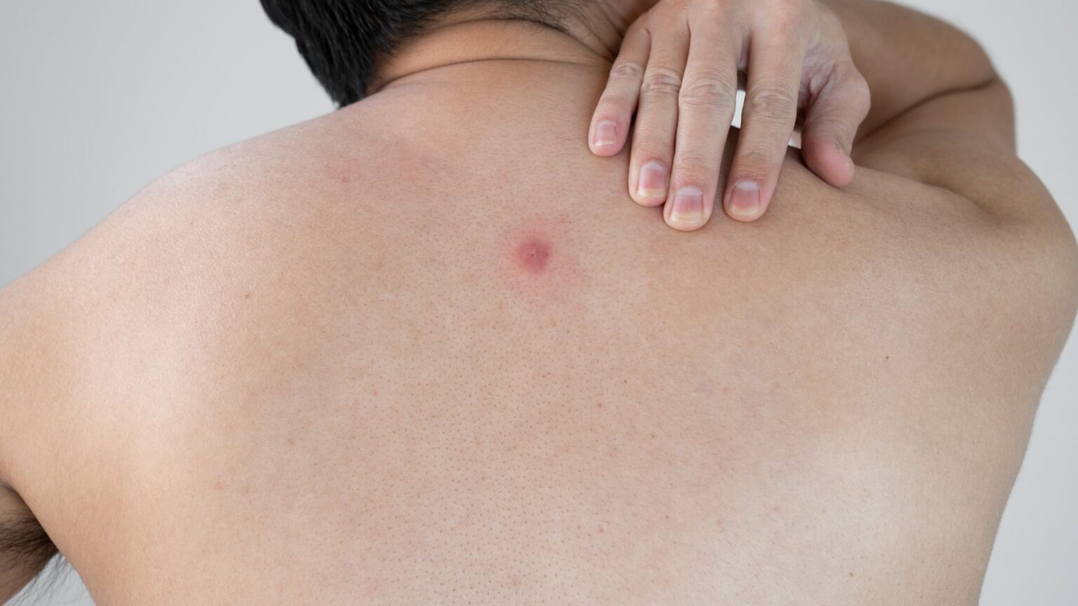 The Ultimate Guide To Drug-Related Skin Abscesses: Supplements, Medicines